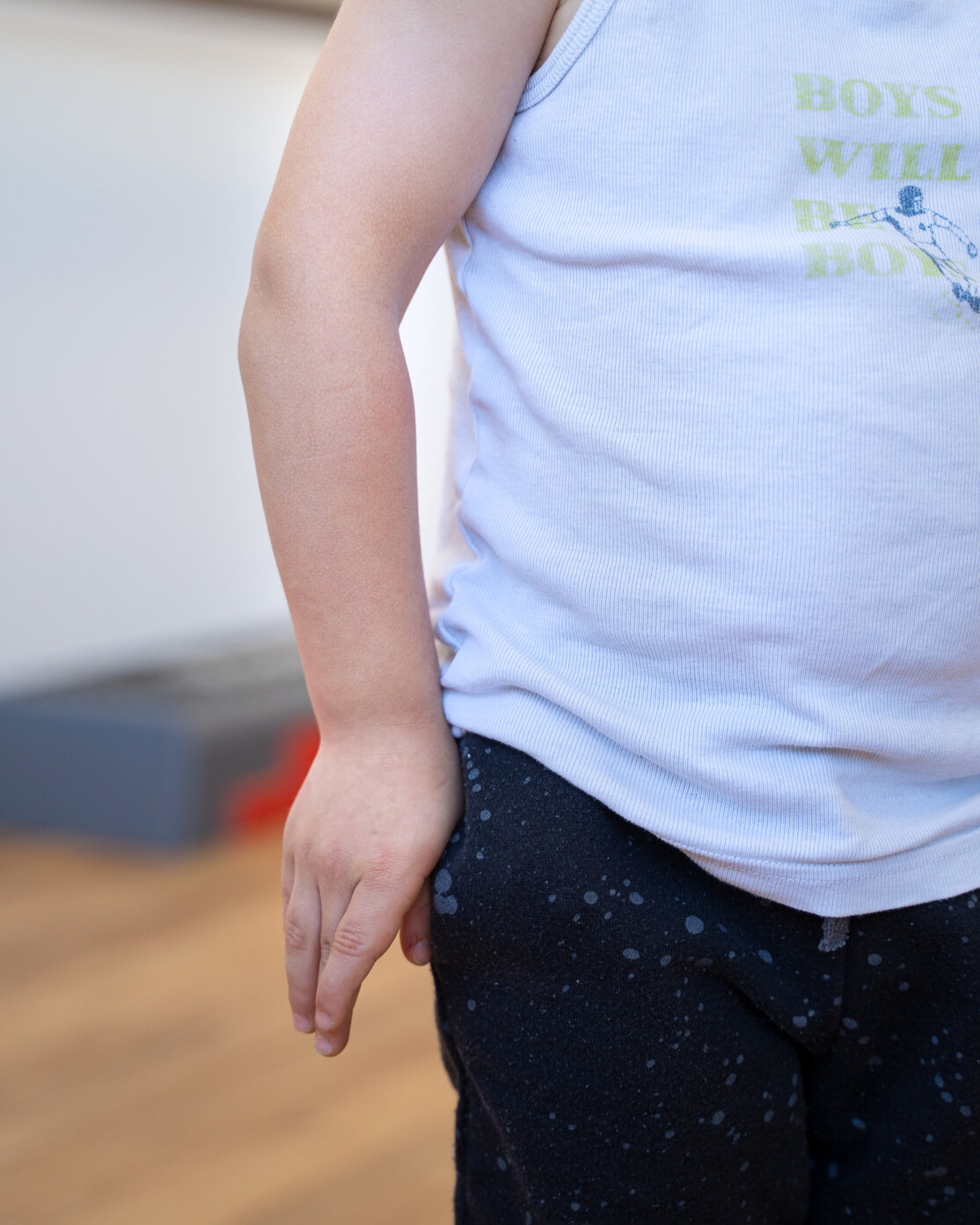 Obstetric brachial plexus palsy: Paralysis of arm nerves