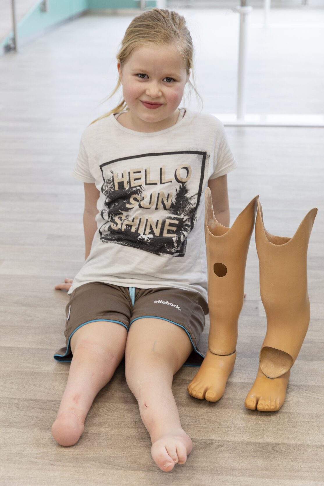 Dysmelia: deformities of arms or legs | Pohlig