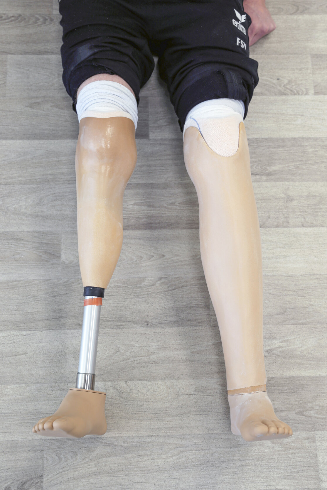 FFU syndrome | Femoral-fibula-ulna syndrome