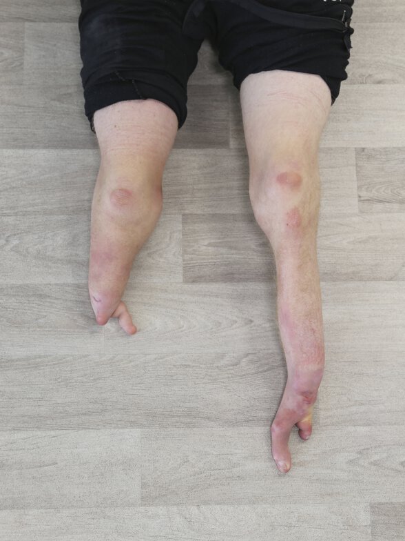 Dysmelia: deformities of arms or legs | Pohlig