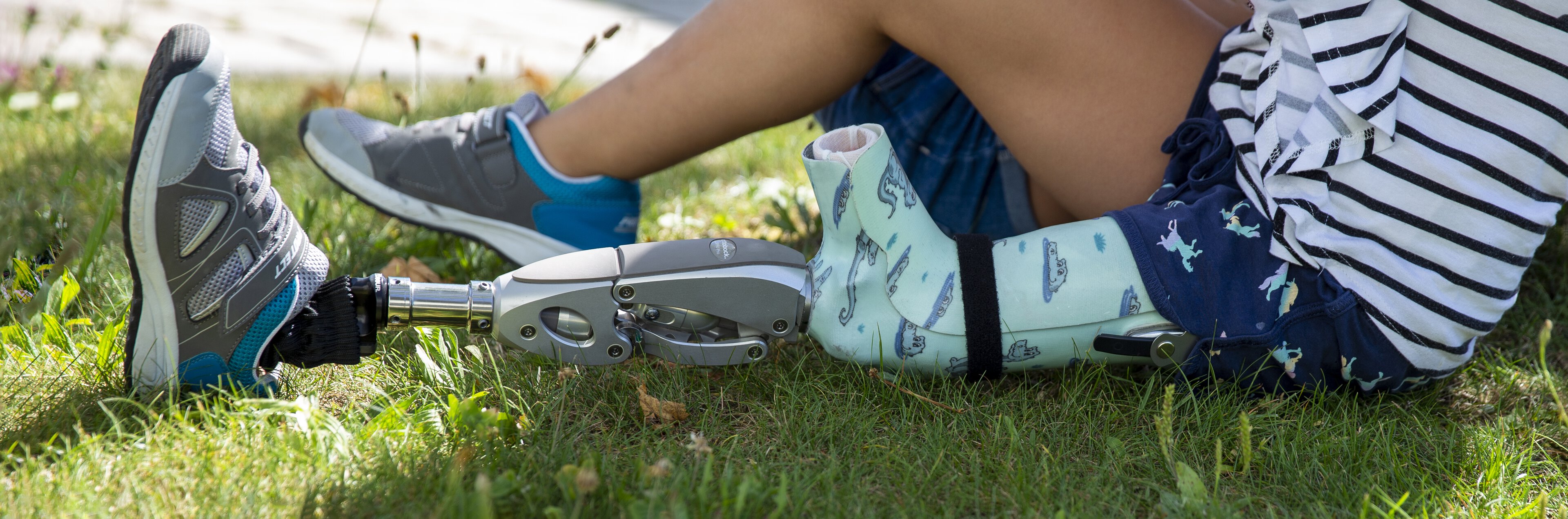 PFFD: Proximal Femoral Focal Deficiency