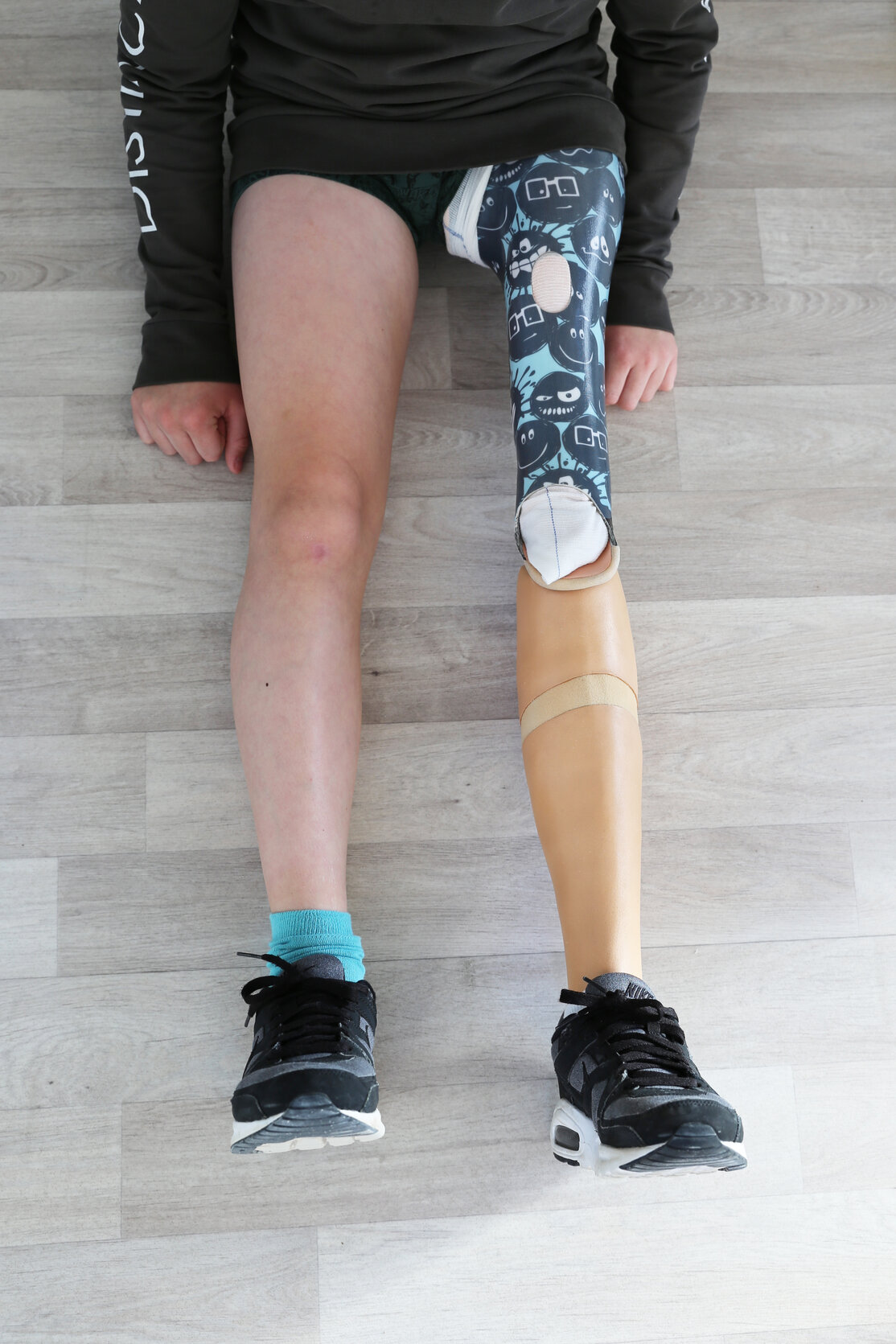 PFFD: Proximal Femoral Focal Deficiency