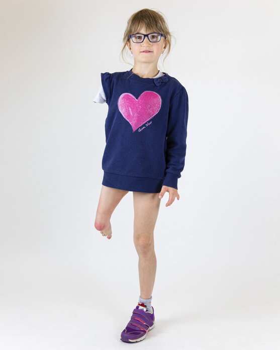 Tibial defect: leg malformation | Pohlig