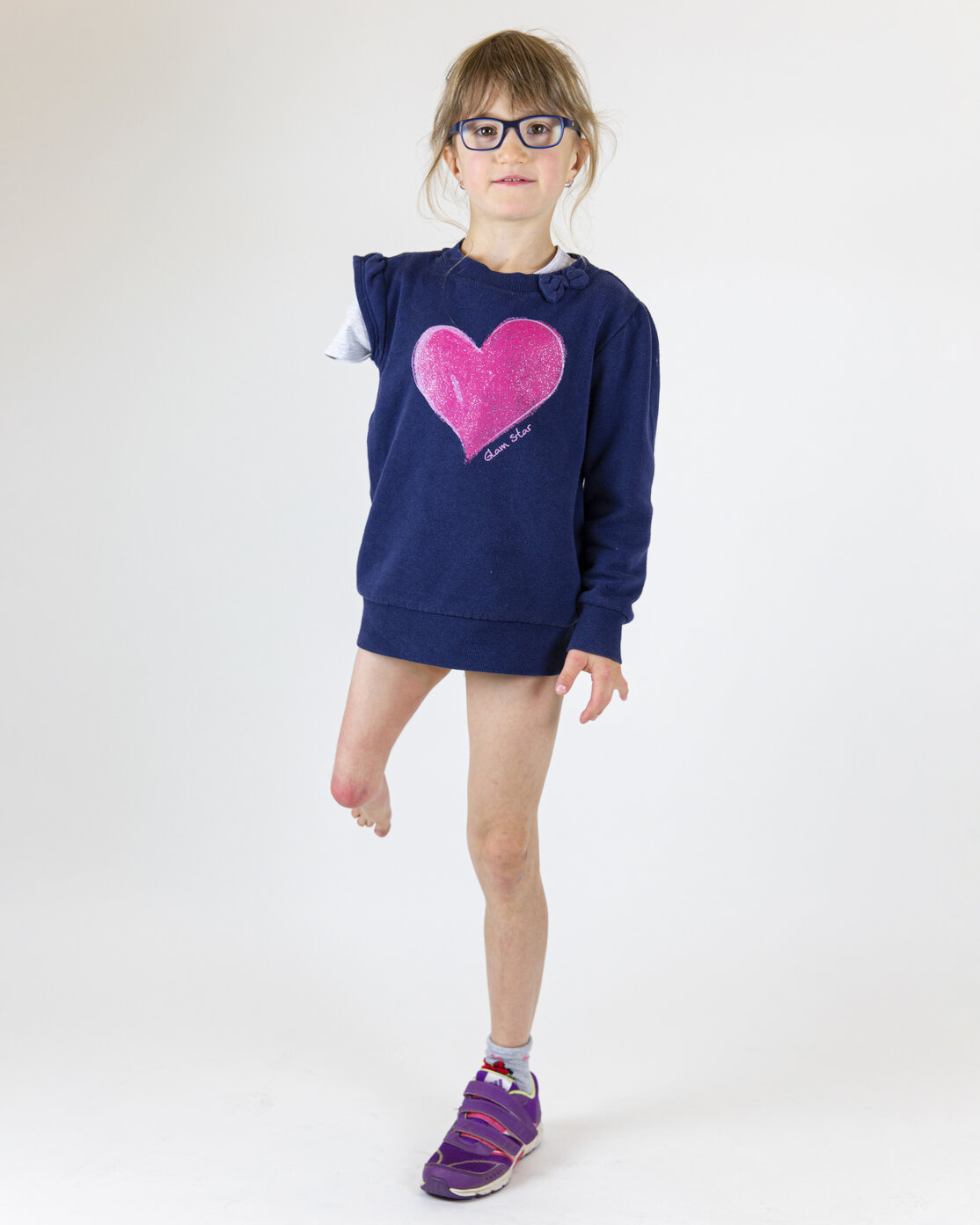 Tibial defect: leg malformation | Pohlig