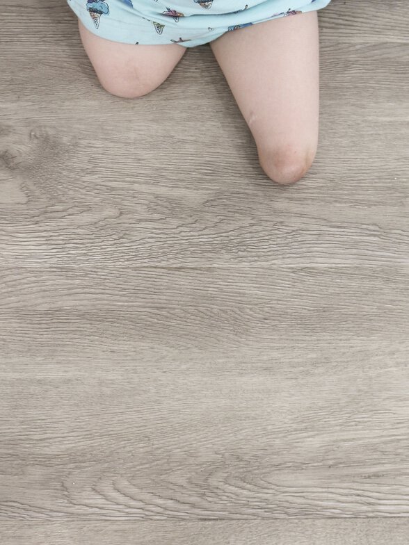 Dysmelia: deformities of arms or legs | Pohlig