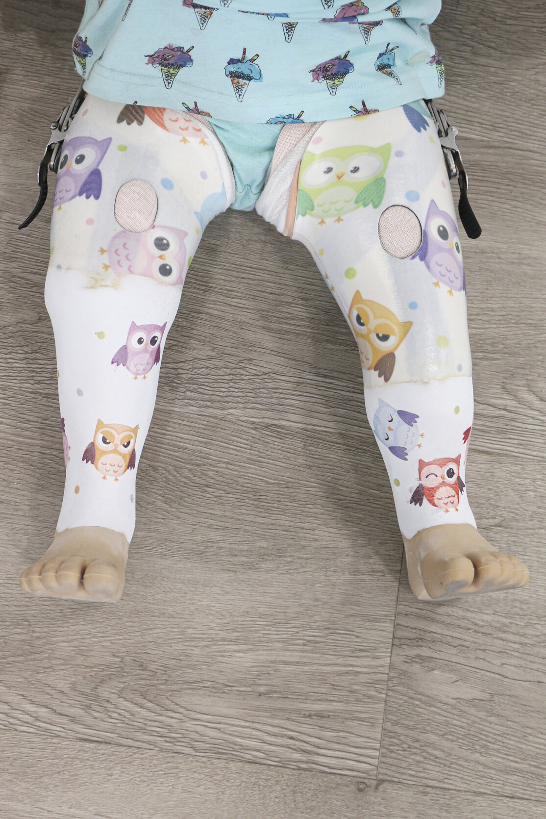 Transverse dysmelia | Orthopedic technology