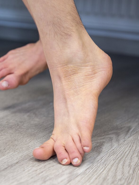 Foot deformities in children: shapes & treatment