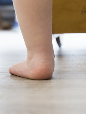 Foot deformities in children: shapes & treatment