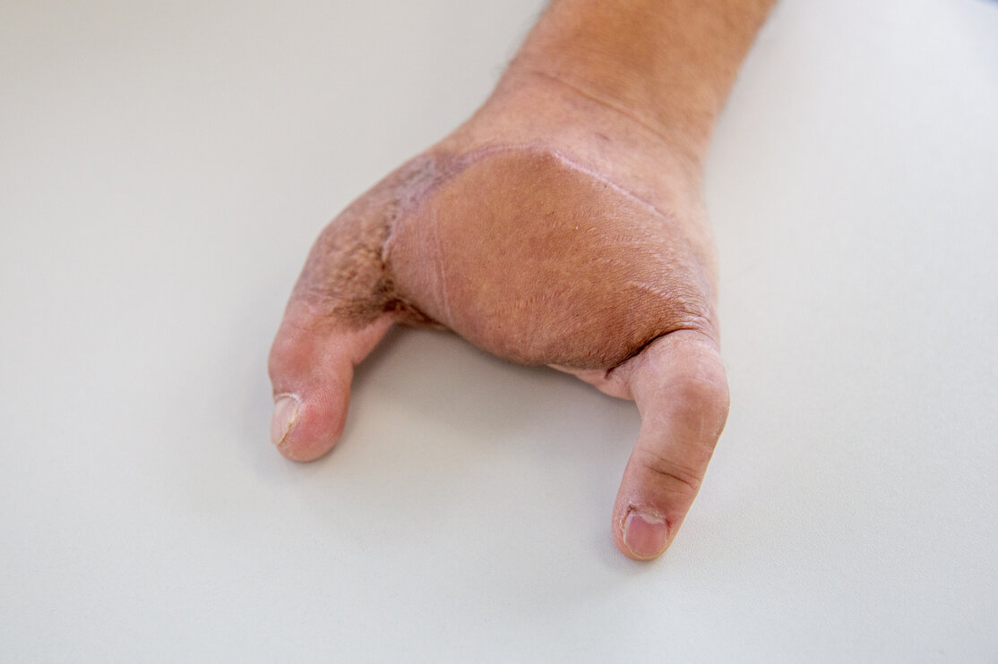 Passive und myoelektrische (Teil-)Handprothese