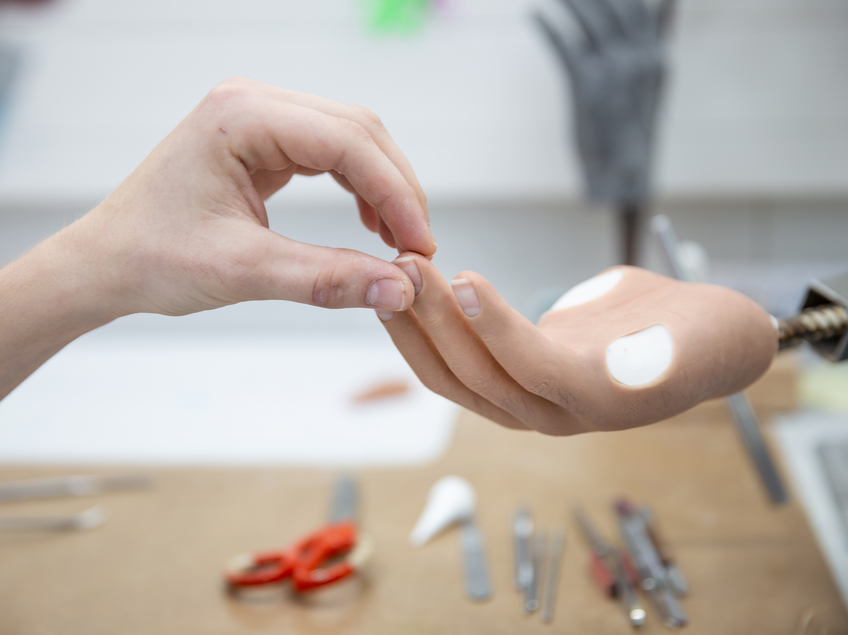 Passive und myoelektrische (Teil-)Handprothese