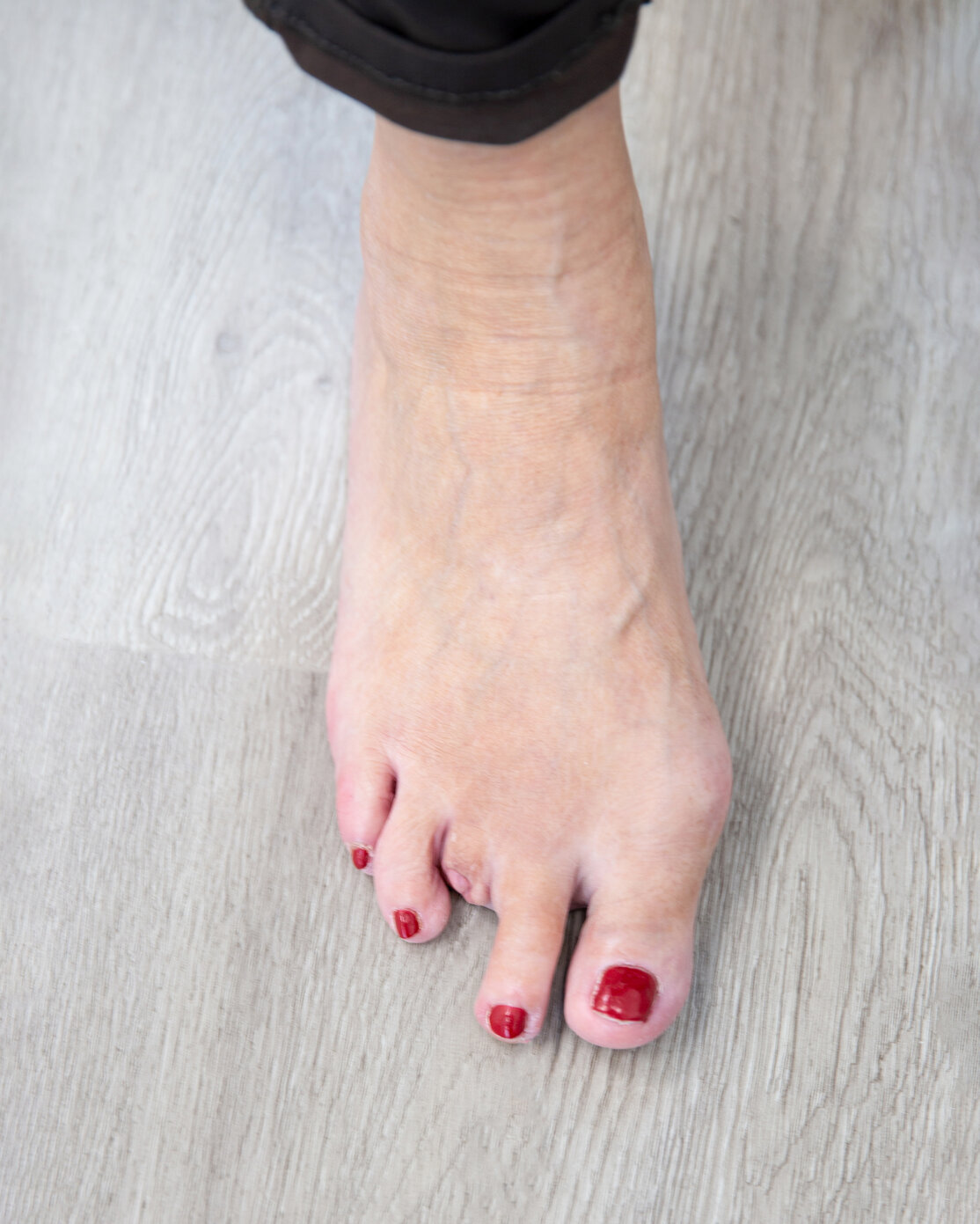 Silicone foot and toe prostheses | Pohlig
